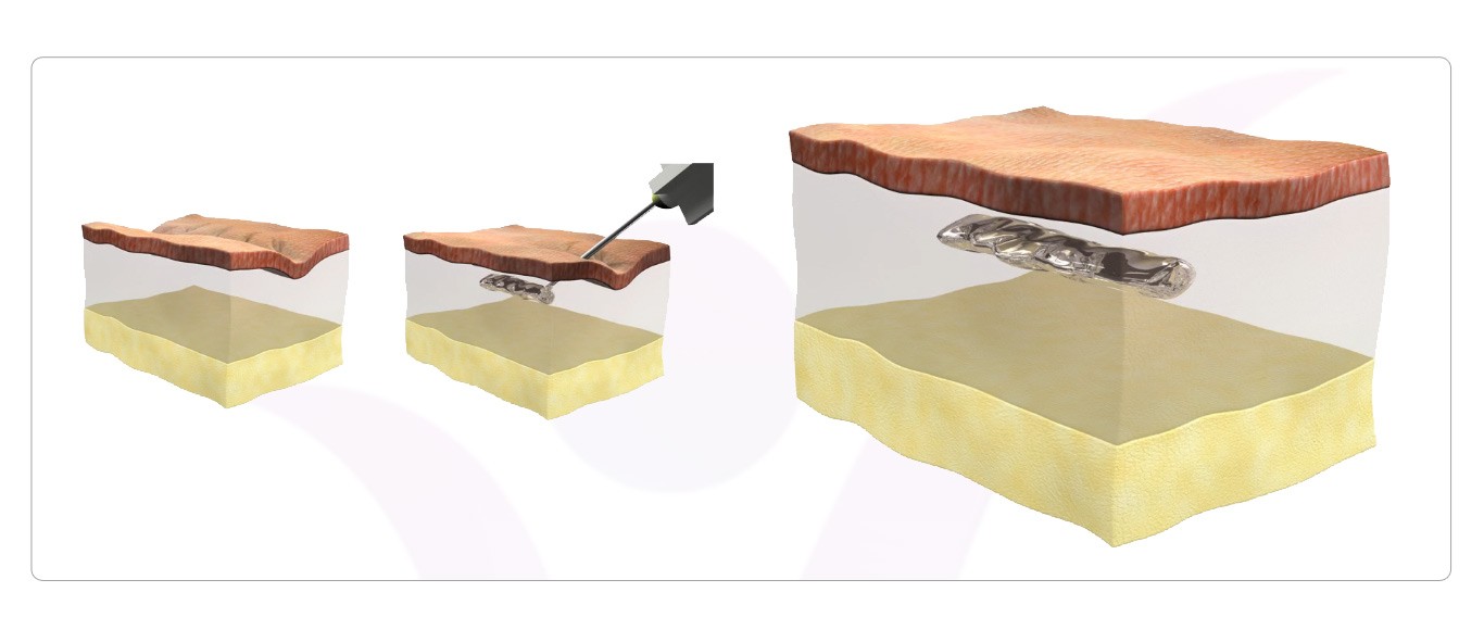 Ácido hialurônico Princess Filler para preenchimento facial ...